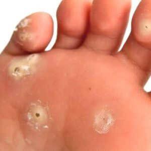 Wratten op voeten, handen en lichaam - Skin Medic