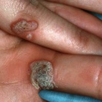 Wratten op voeten, handen en lichaam - Skin Medic