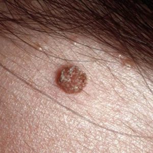 Wratten op voeten, handen en lichaam - Skin Medic