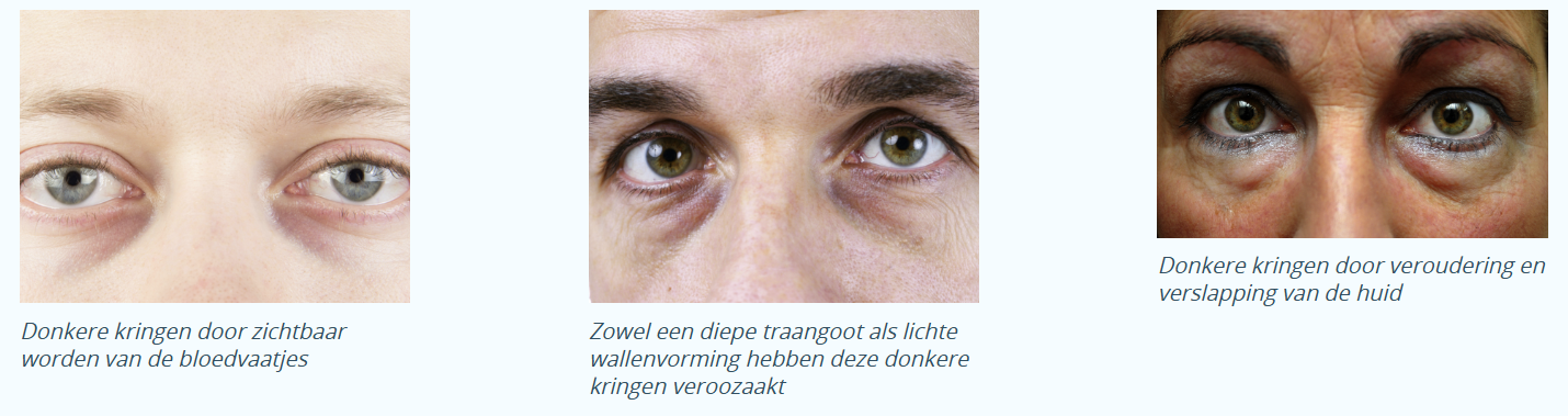 Donkere kringen onder de ogen - Skin Medic